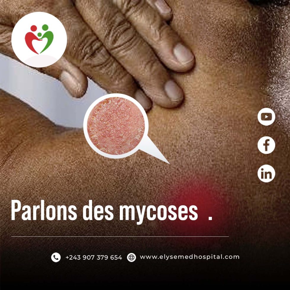 Parlons De Mycoses - Elysemed Hospital